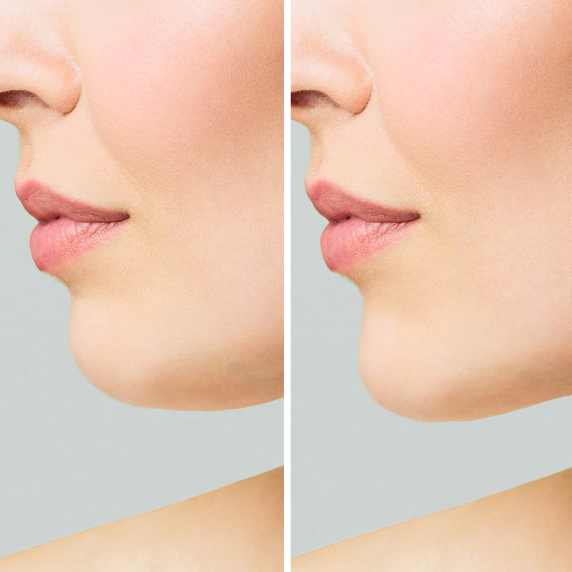 Chin Implants - Chin and Jawline Surgery - Santa Rosa