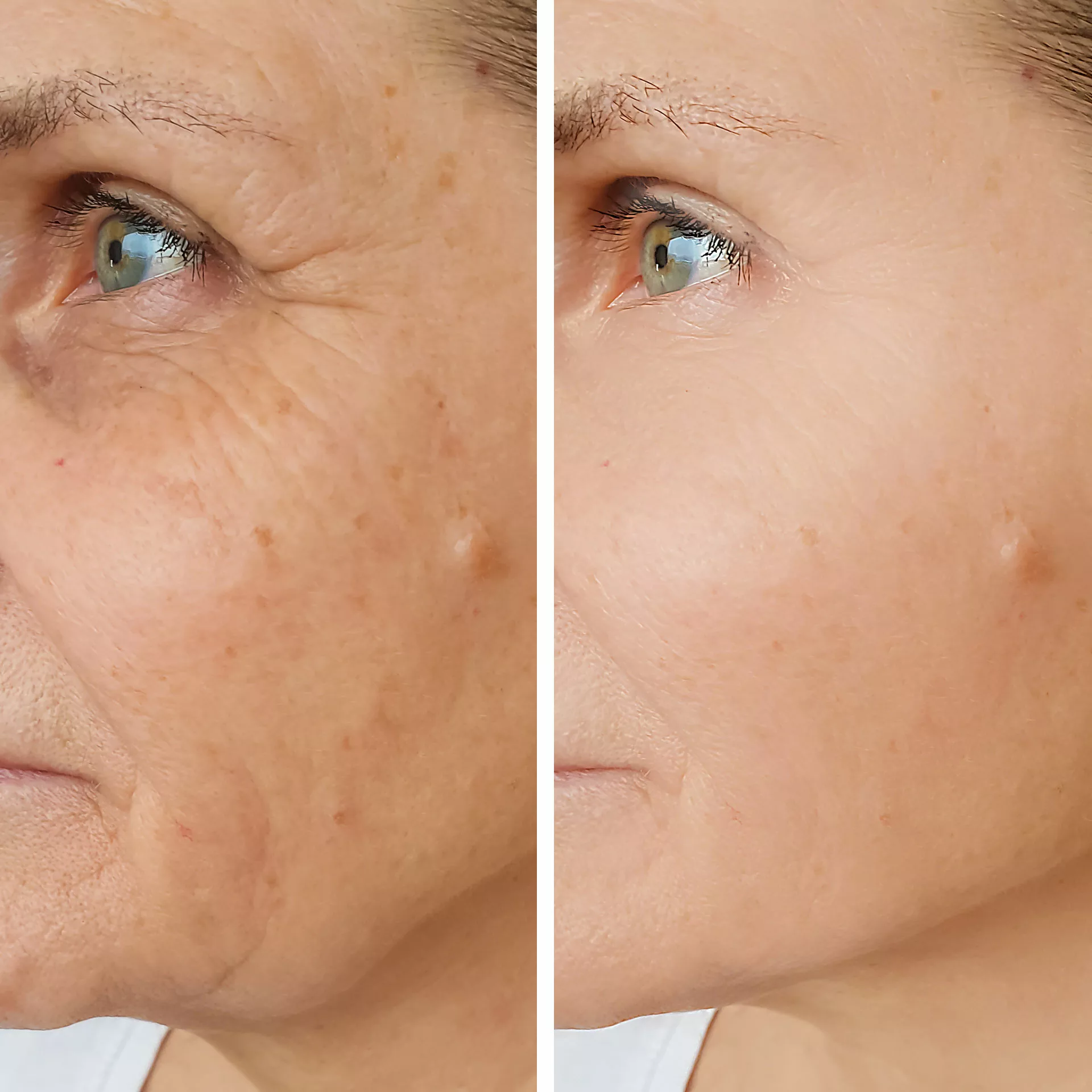 Sculptra Aesthetic - Injectable Filler - Santa Rosa and Healdsburg