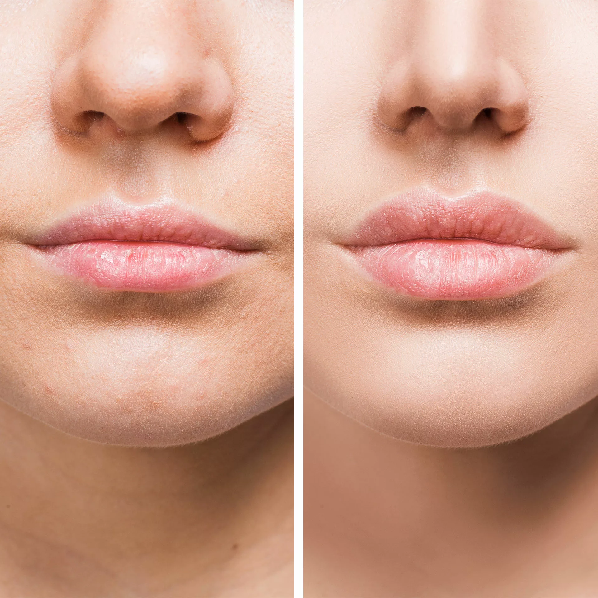 Restylane Before And After Lips