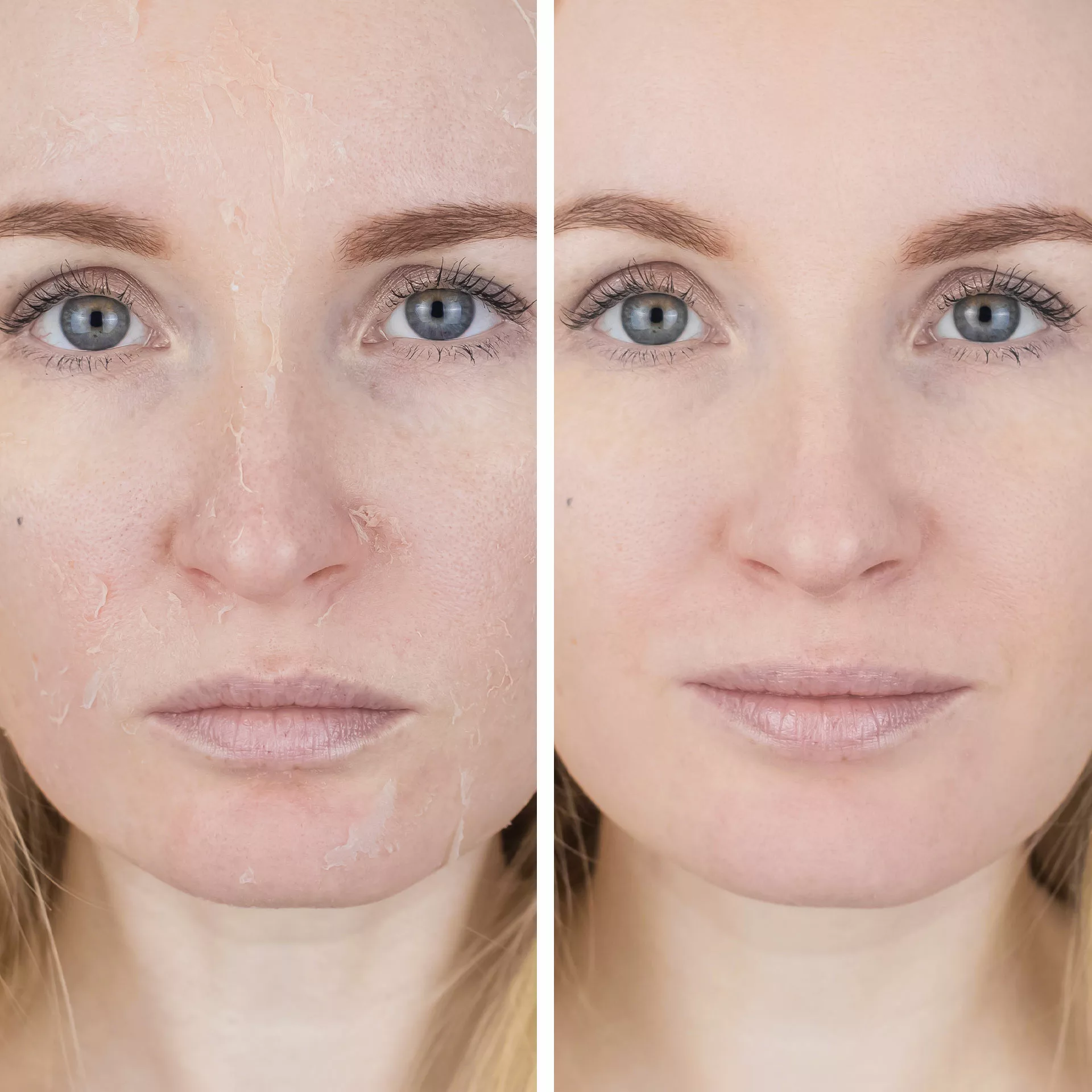 Pixel Peels - Microneedling and Chemical Peel - Santa Rosa