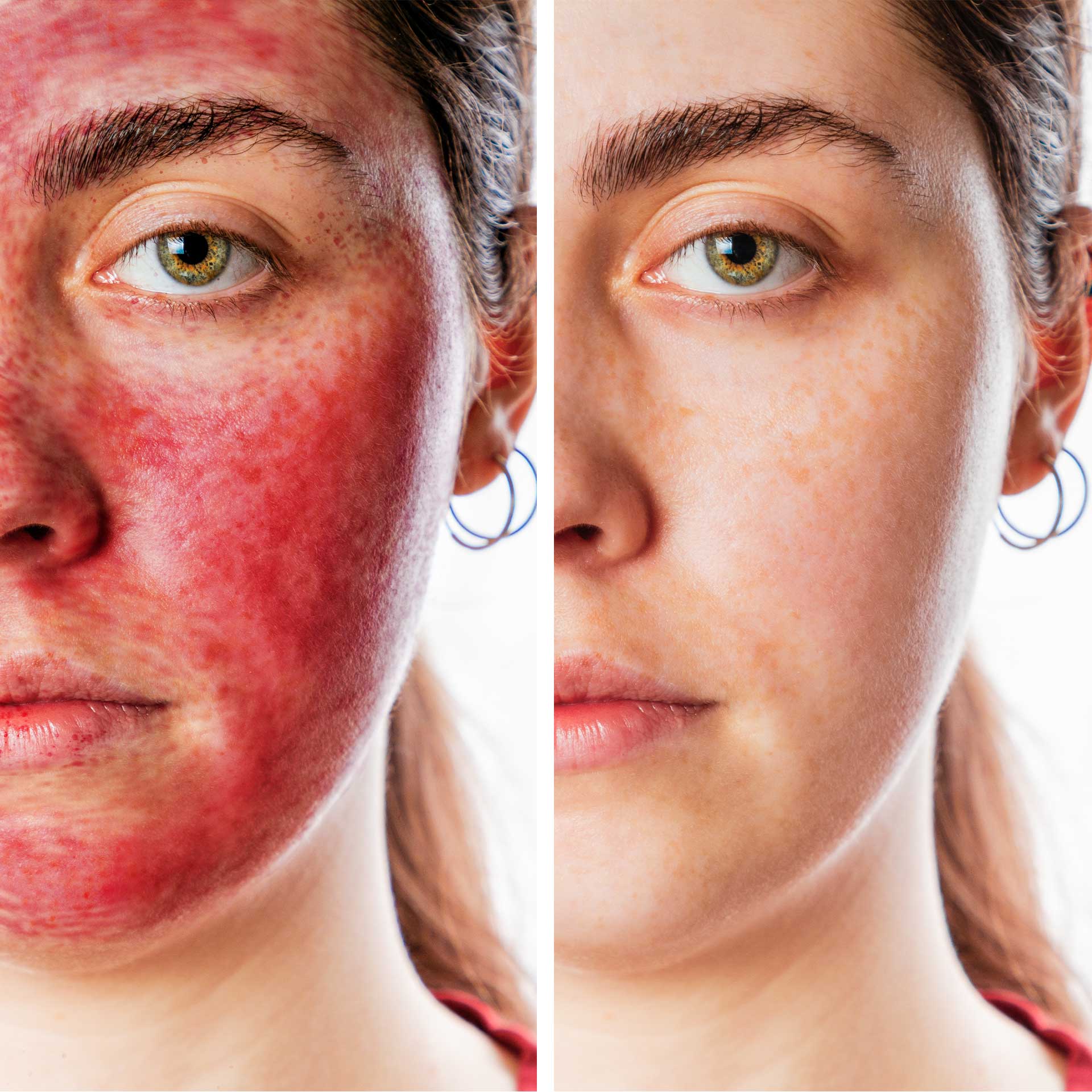 PRP Facial - “Vampire” Facial - Santa Rosa and Healdsburg