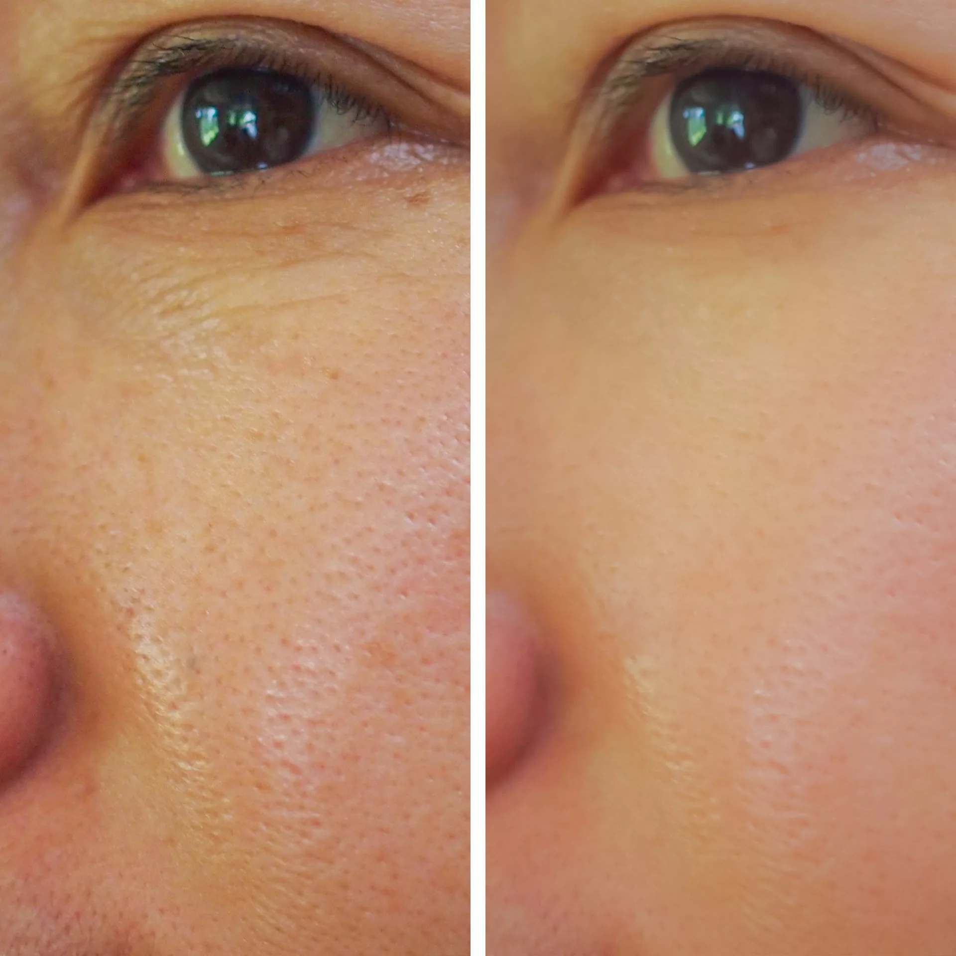 Vivace Ultra - RF Microneedling - Santa Rosa and Healdsburg