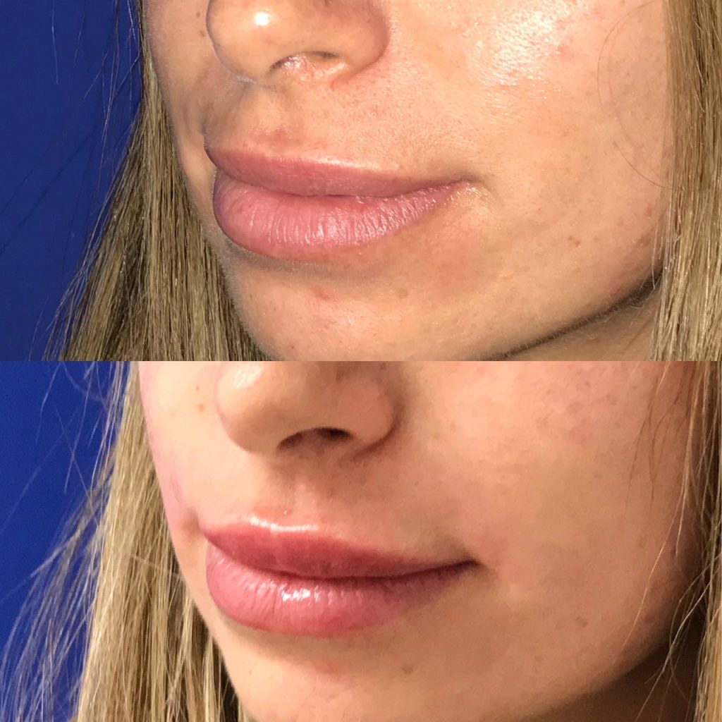 Restylane Kysse - Lip Filler - Santa Rosa and Healdsburg