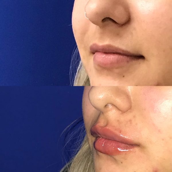 Restylane Kysse - Lip Filler - Santa Rosa and Healdsburg