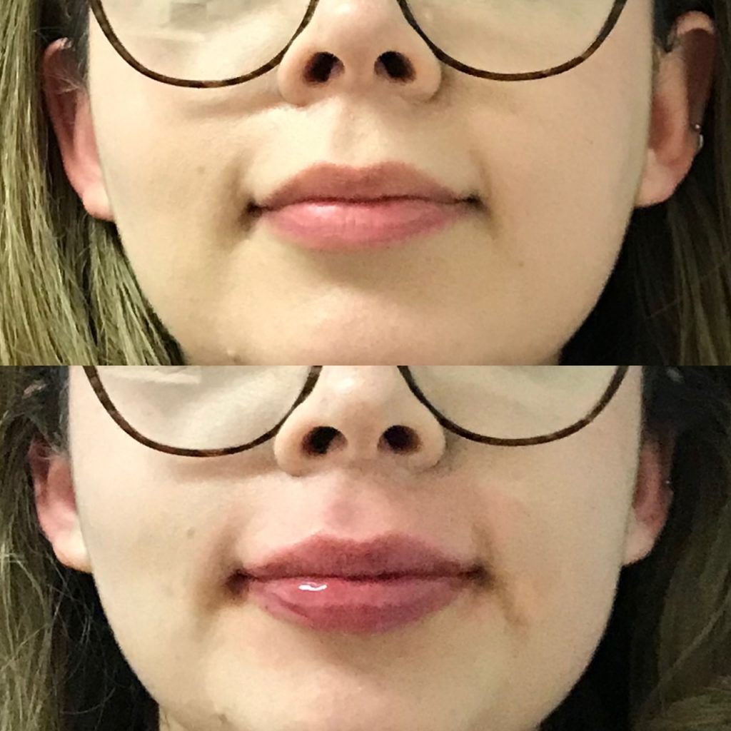 Restylane Kysse - Lip Filler - Santa Rosa and Healdsburg