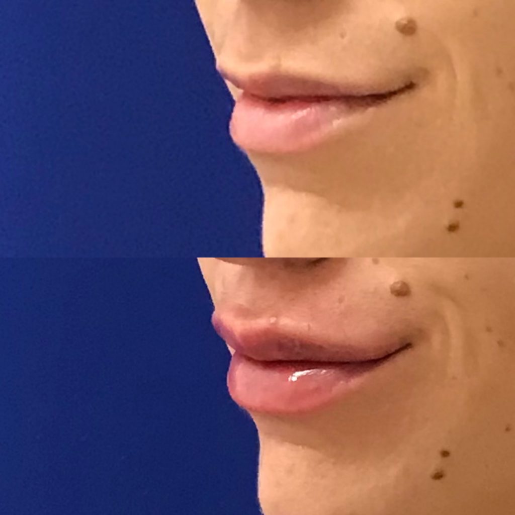 Restylane Kysse - Lip Filler - Santa Rosa and Healdsburg