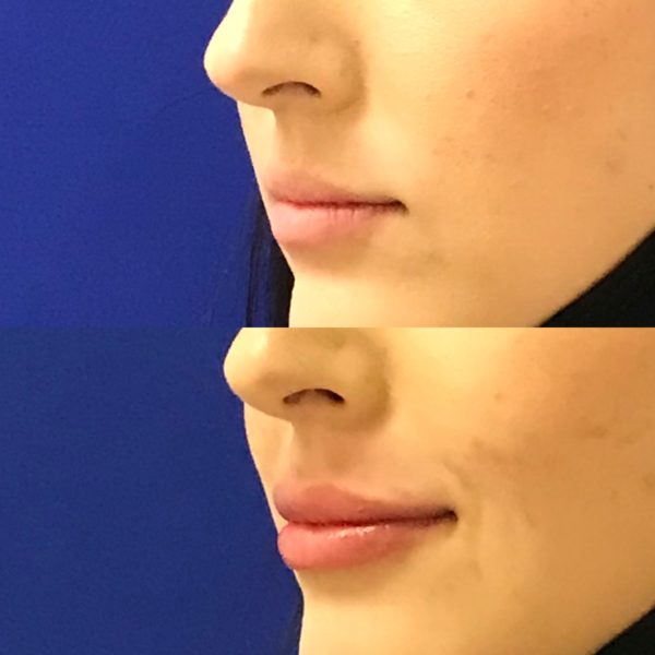 Restylane Kysse - Lip Filler - Santa Rosa and Healdsburg
