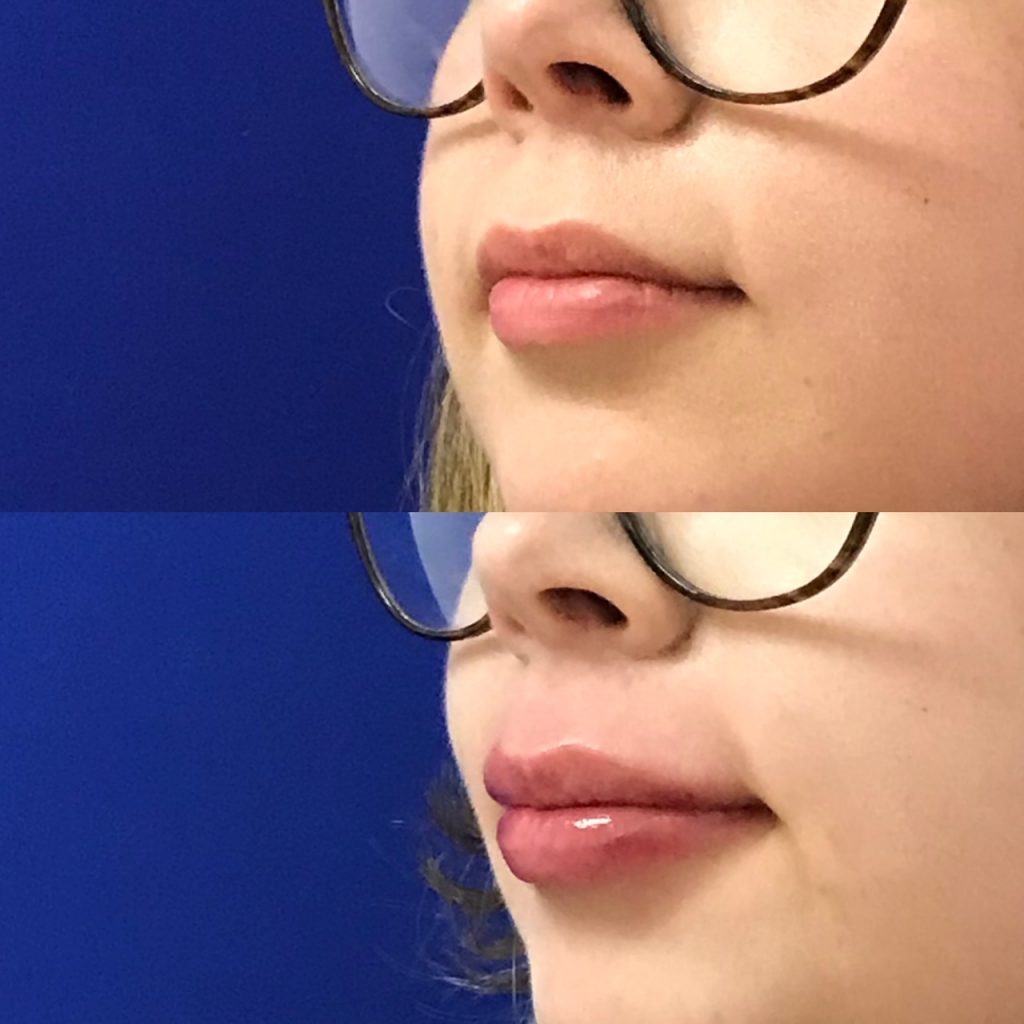 Restylane Kysse - Lip Filler - Santa Rosa and Healdsburg