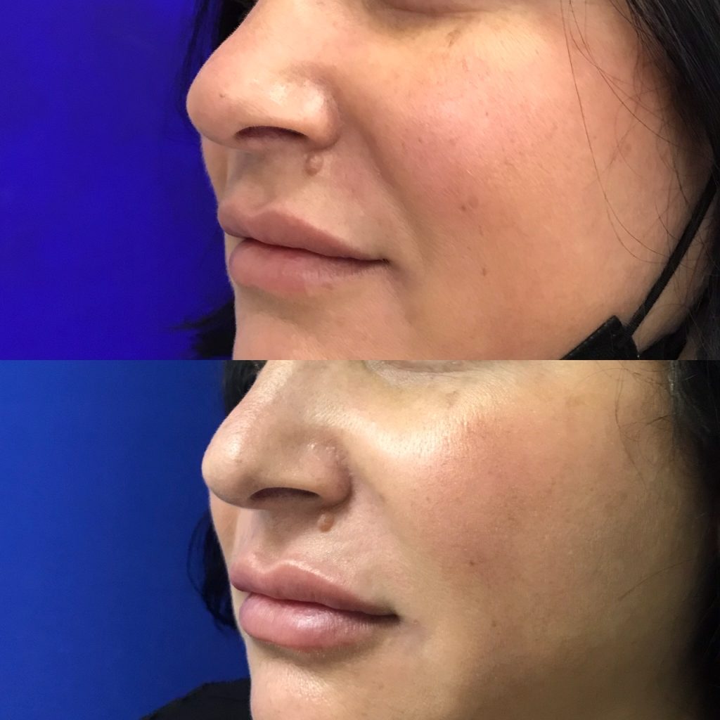 RHA Collection - Injectable Filler - Santa Rosa and Healdsburg