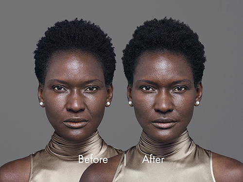 The RHA Collection: The World’s First Dynamic Dermal Filler