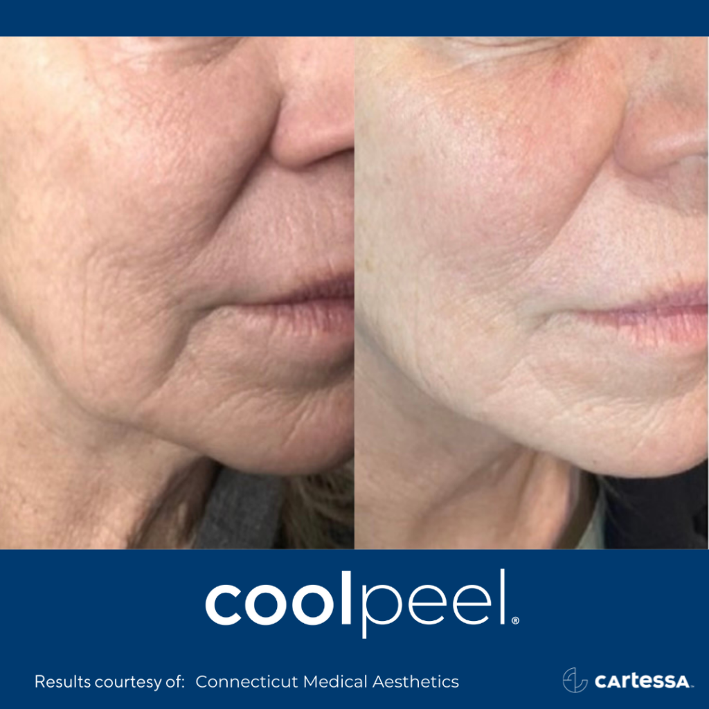 CoolPeel Laser Resurfacing (to Reverse Signs of Aging) at Artemedica
