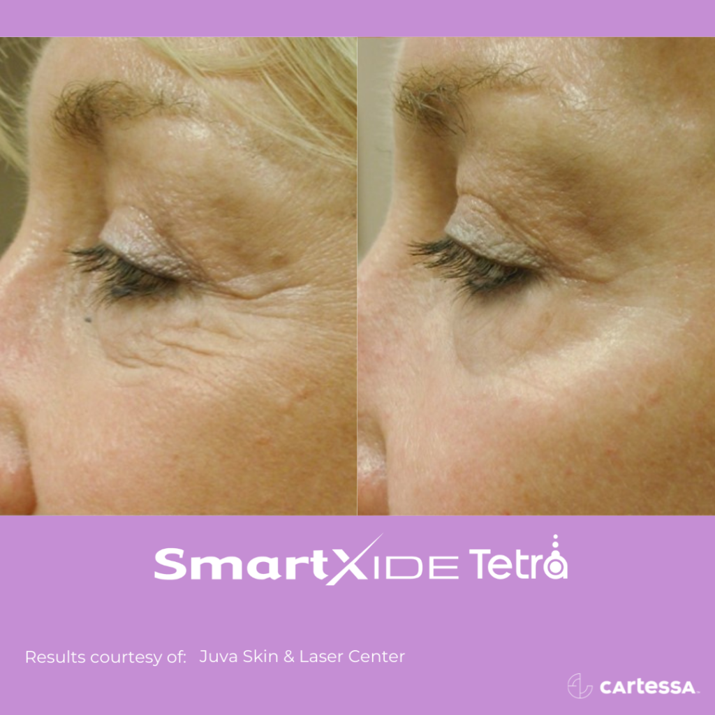 Tetra CO2 Laser Resurfacing In-Office Facial Skincare Treatment