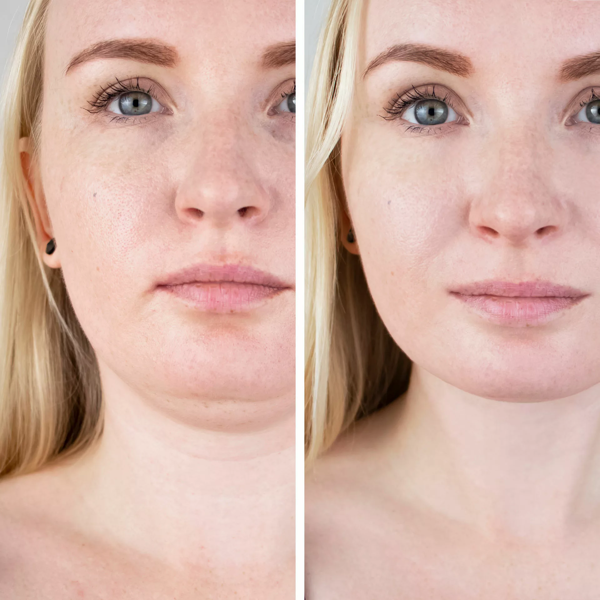 EMFACE - Non-invasive Facelift - Santa Rosa and Healdsburg