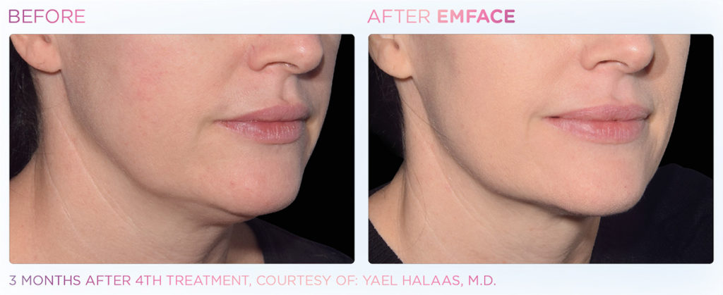 EMFACE - Non-invasive Facelift - Santa Rosa and Healdsburg